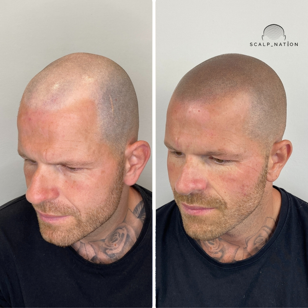 Scalp Micropigmentation Before And After Photos | Scalp Nation