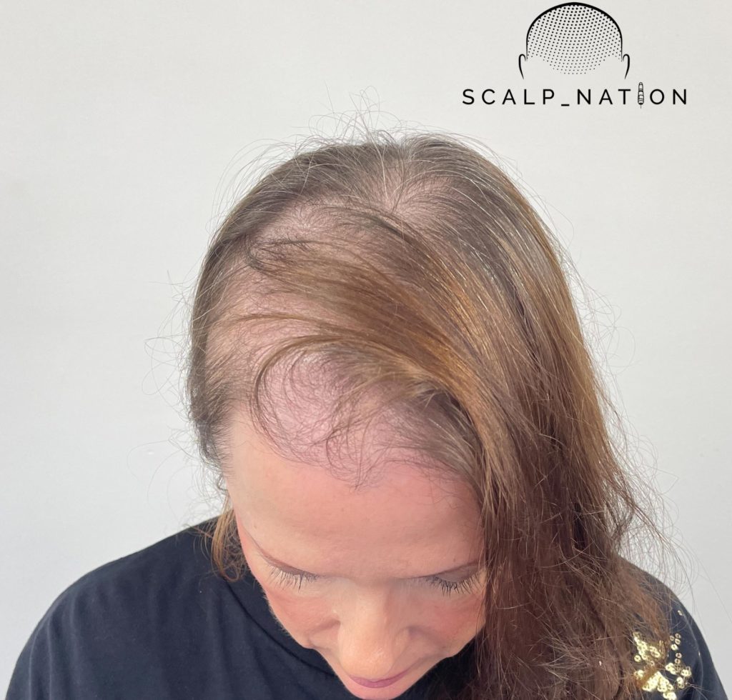 Hair Follicle Problems and Treatments | Scalp Nation