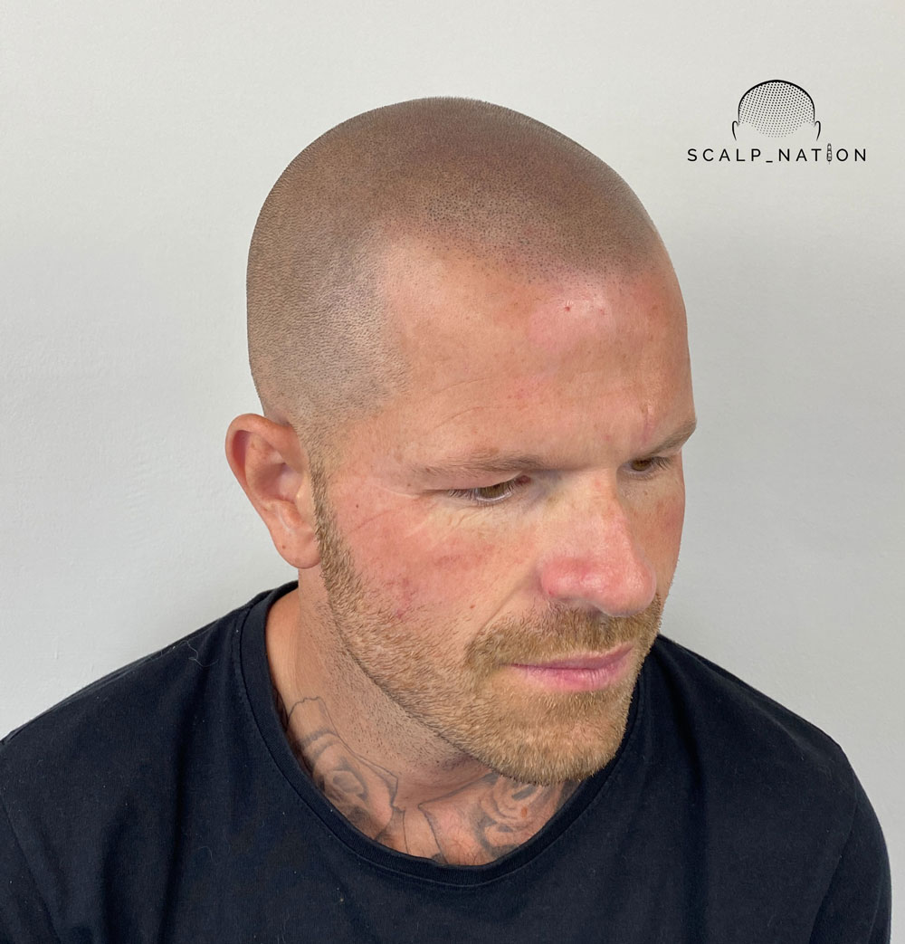 Bald Style Trends, Redefine Confidence | Scalp Nation
