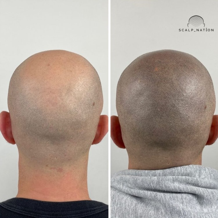 Why Do Men Go Bald: Causes of Hair Loss | Scalp Nation